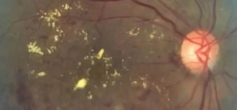 Common Retinal Disorders – Southeast Retina Center